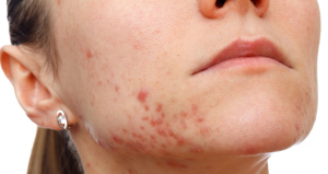 Sivex Losyonu Sivilceleriniz İçin Denemediyseniz Hemen Deneyin! - Cilt ...