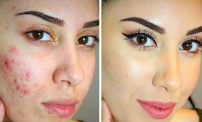 Benzalin Topikal Jel (Krem) Niçin Kullanılır? - Cilt Bakımım - Cilt Bakımım